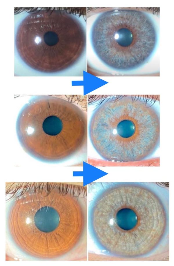 Images of before and after the treatment of eye color change - Eyecos ...