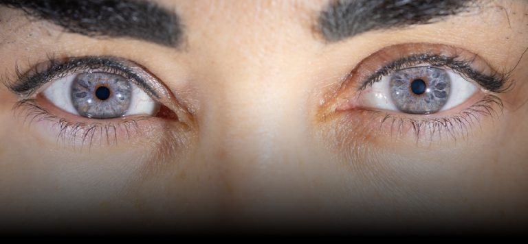 Clínica Eyecos - Cambio del color de los ojos mediante láser